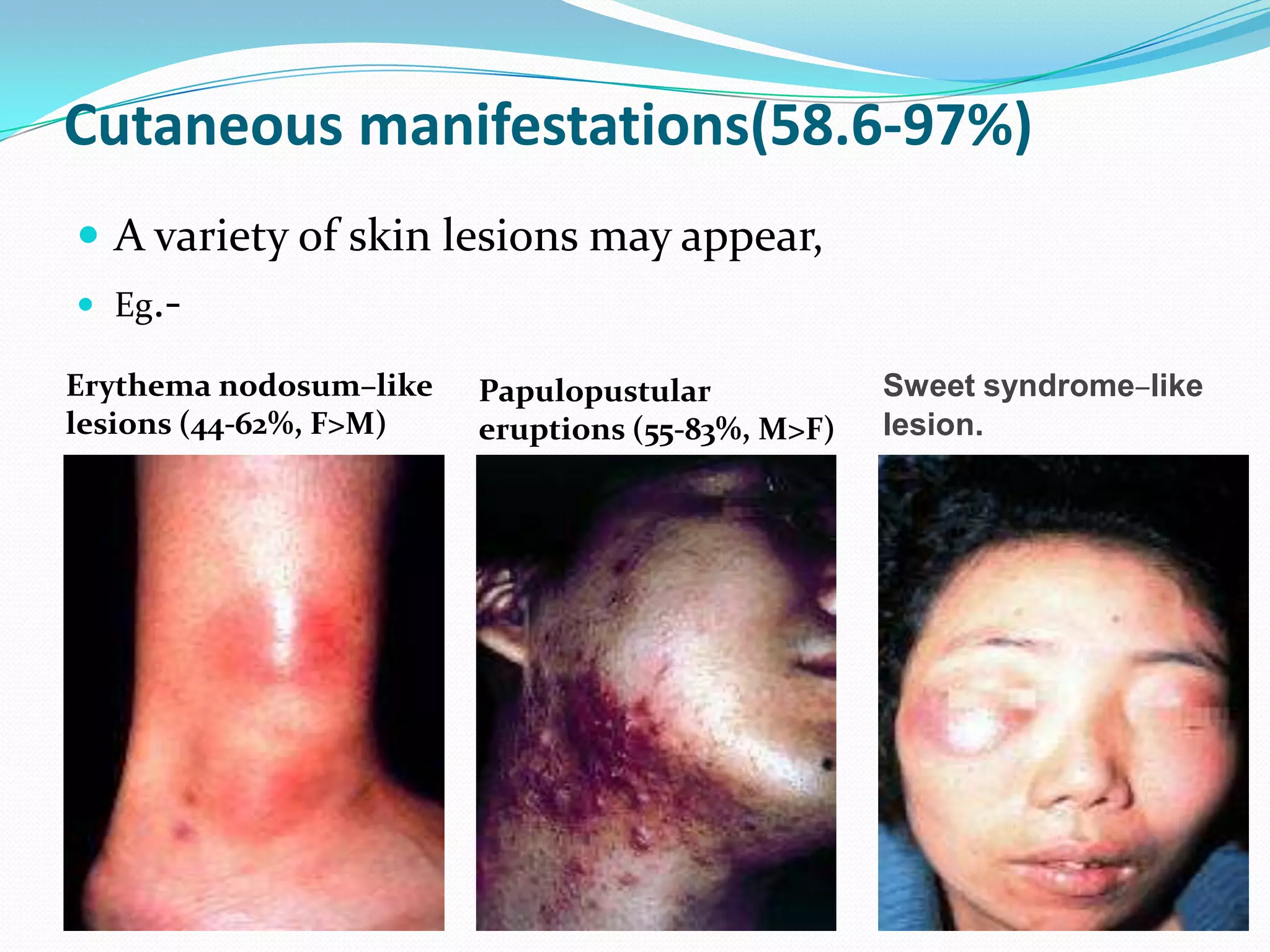 Behcet's disease | PPTX