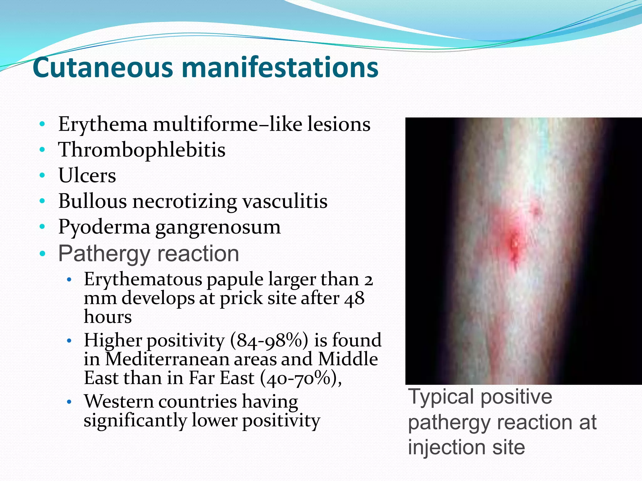 Behcet's disease | PPTX