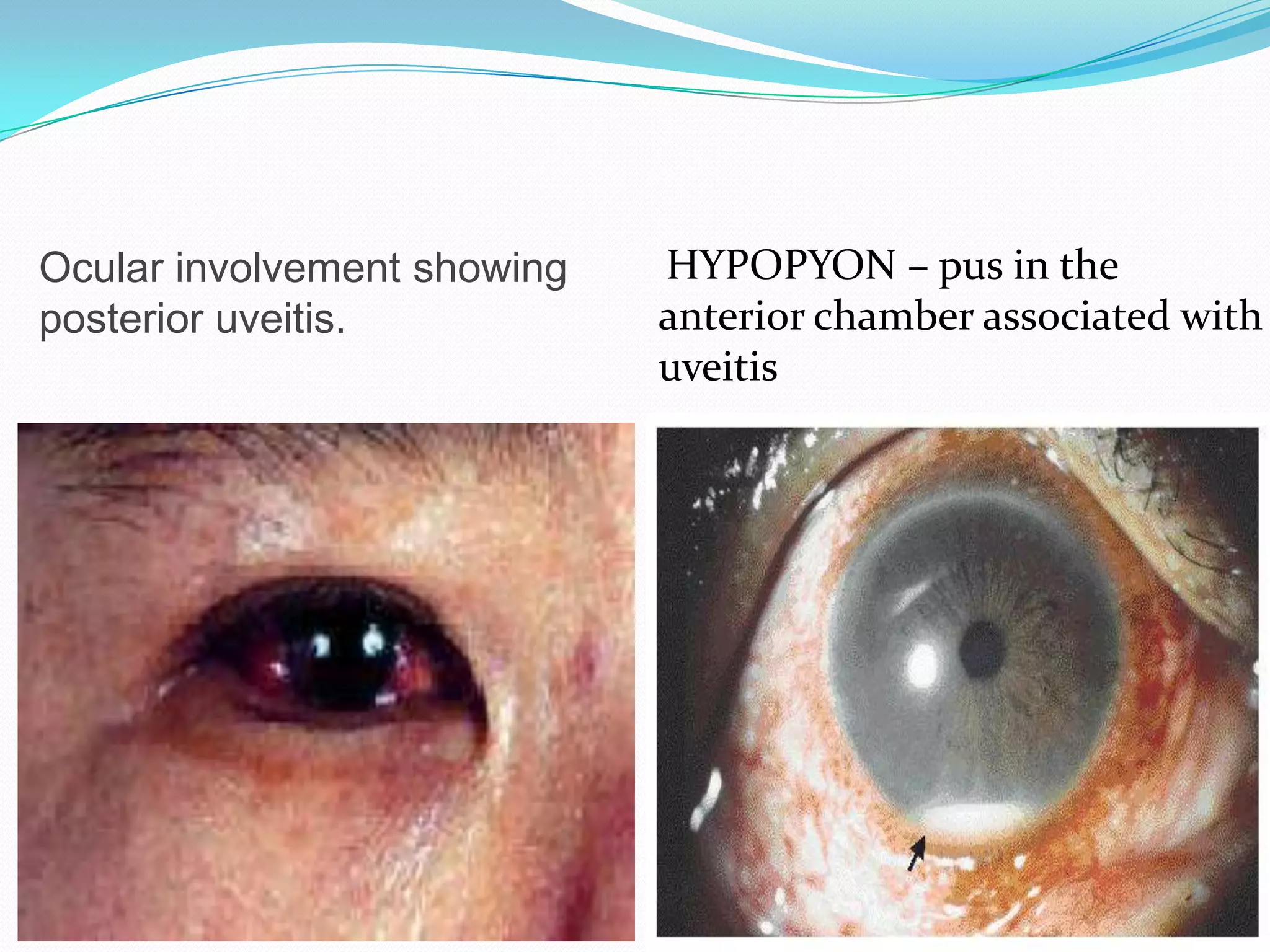 Behcet's disease | PPTX