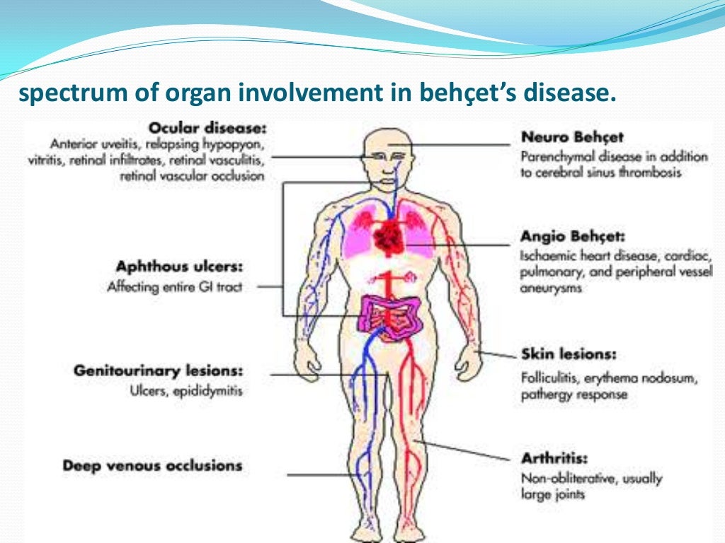 Behcet's disease