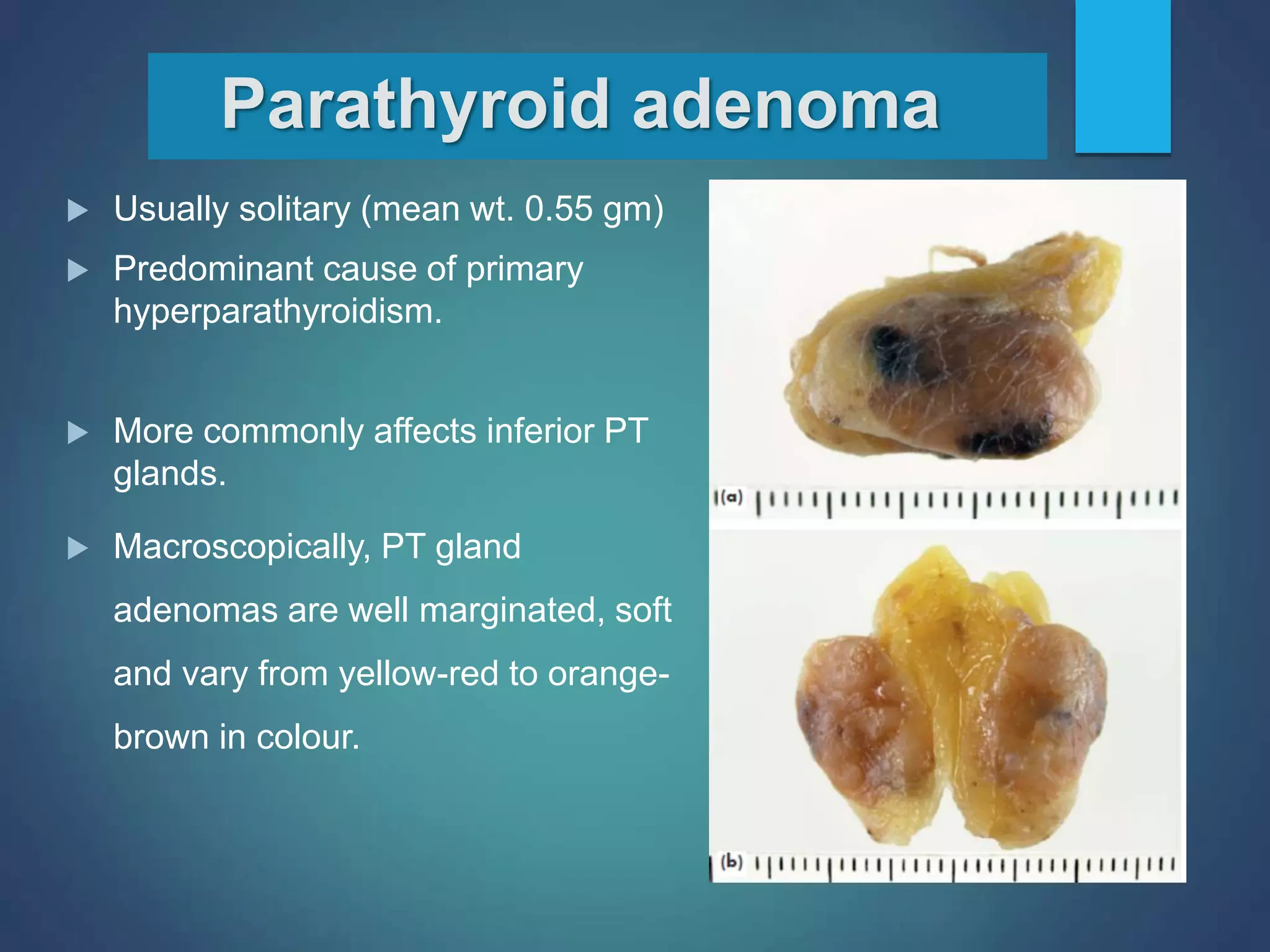 Parathyroid gland anatomy, its disorders and manangement | PPT