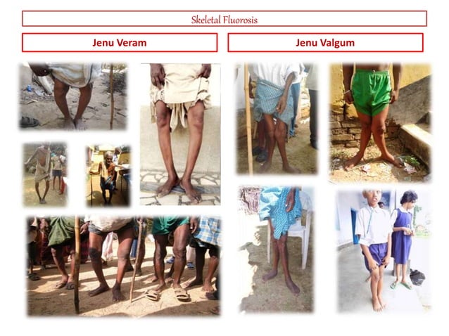 Dr dutta nppcf fluorosis_2nd half | PPTX | Dental Health | Diseases and ...