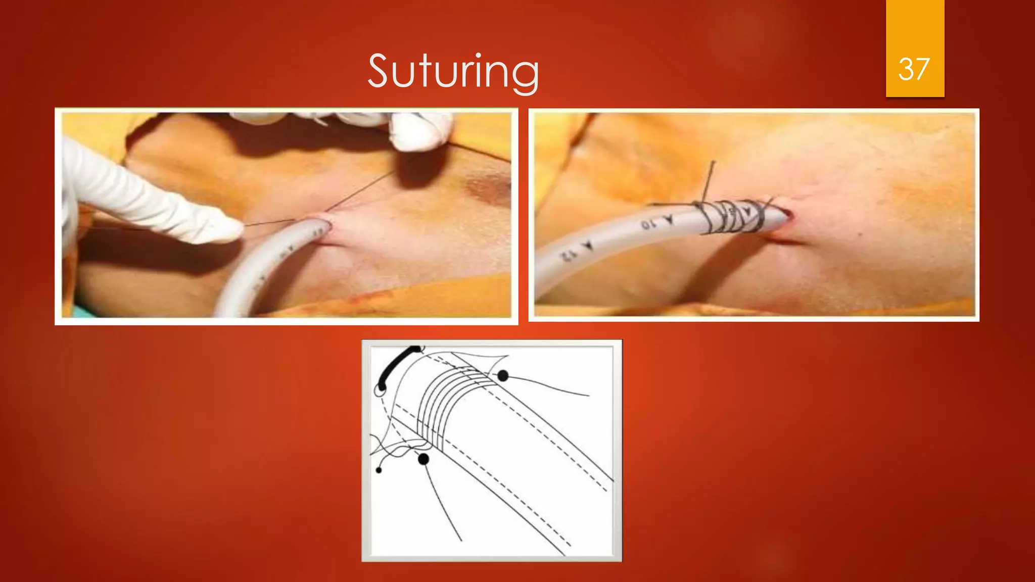 Tube Thoracostomy DR ELLAHI BAKHSH | PPTX