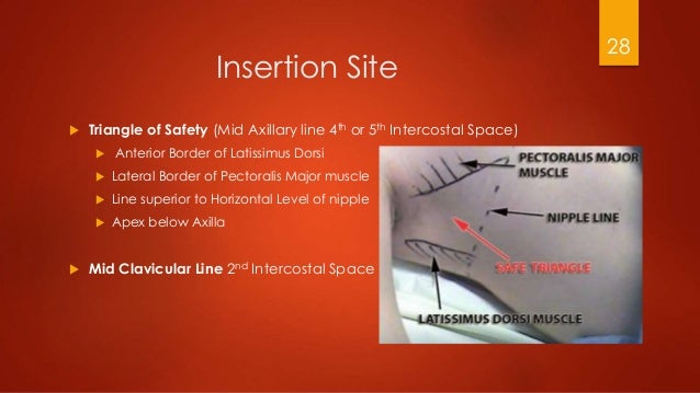 Tube Thoracostomy DR ELLAHI BAKHSH