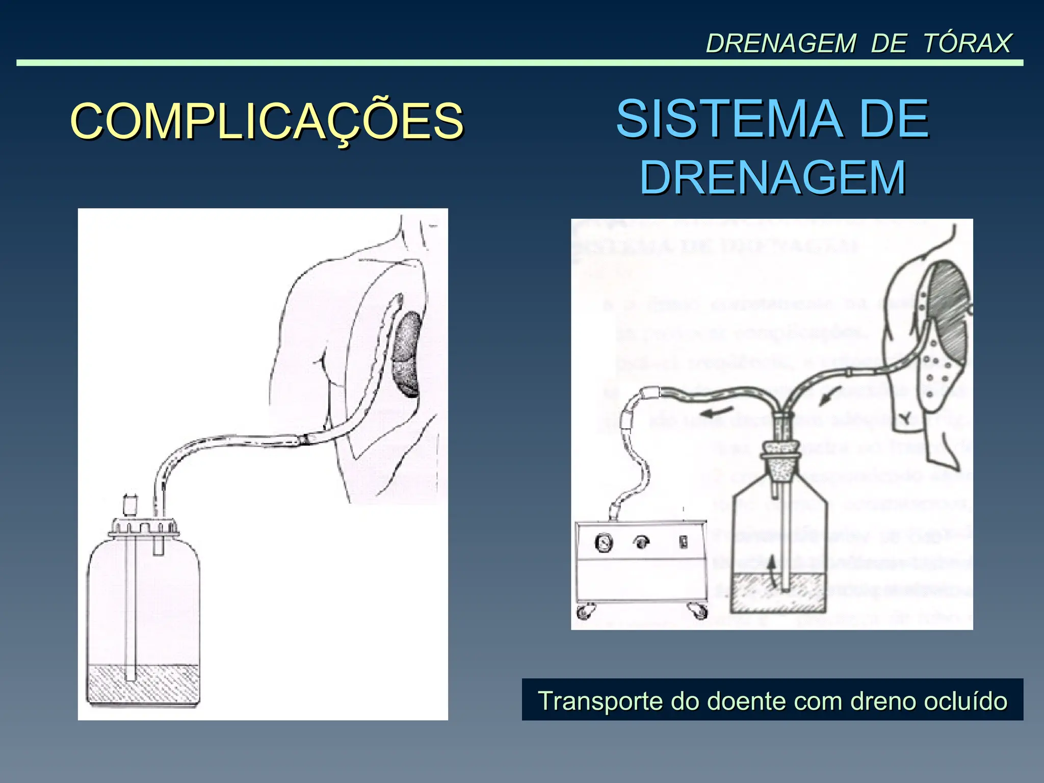 Drenagem Torácica atualizado drenagemtorax.ppt