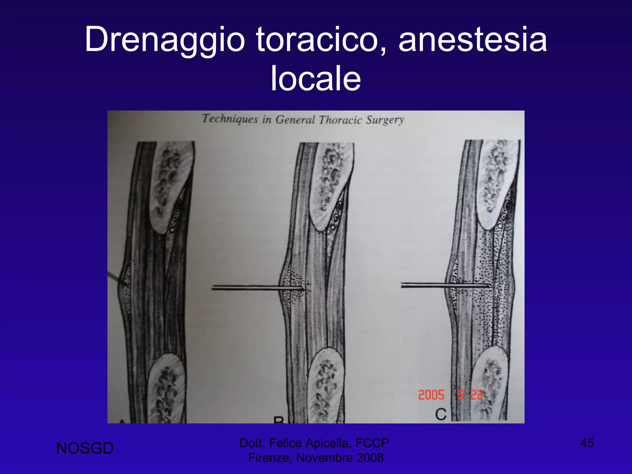 Il drenaggio toracico | PPT