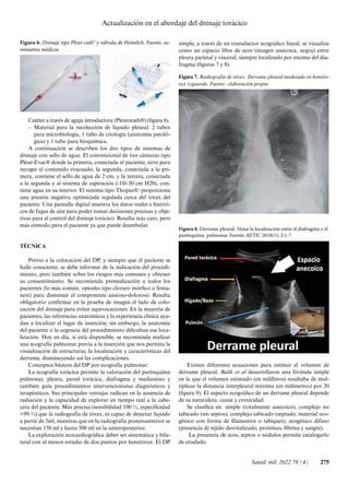 Derrame Pleural Con Catéter Pigtail