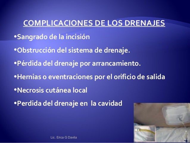 Drenajes abdominales2208
