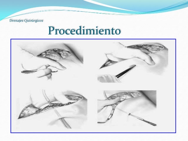 Drenajes quirúrgicos