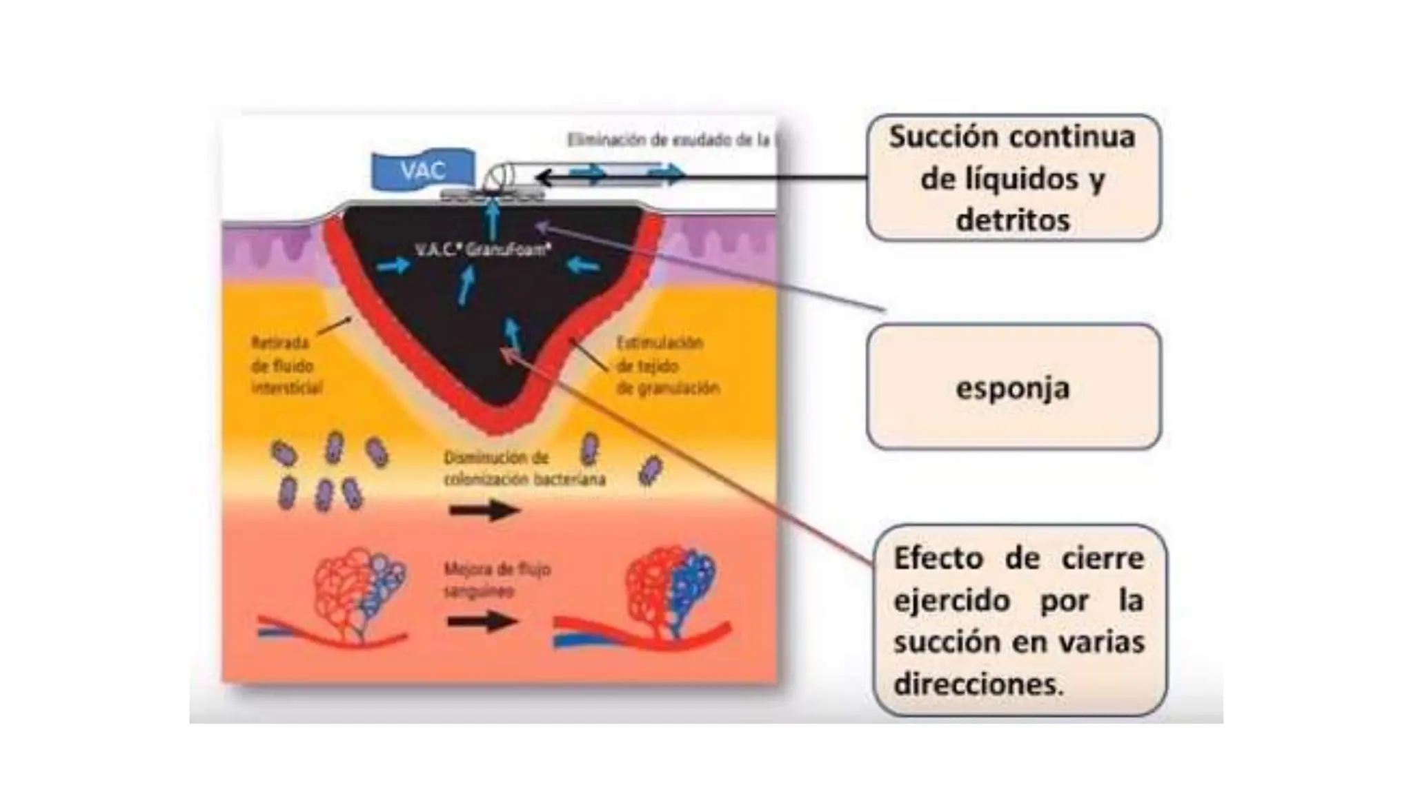 TIPOS DE DRENAJES QUIRURGICOS, FUNCION Y TIPO DE CIRUGIA | PPTX