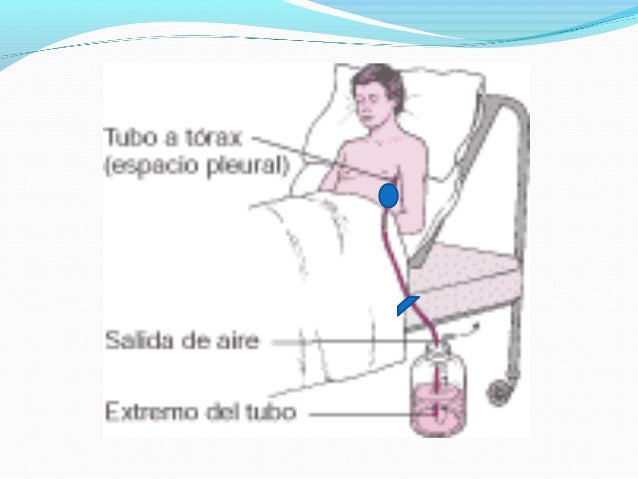 Drenaje torácico