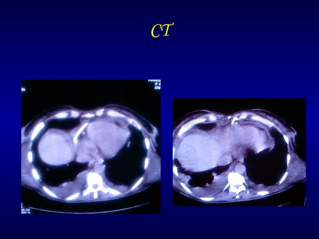 Drenajul pericardic percutan in pericardita neoplazica | PPT
