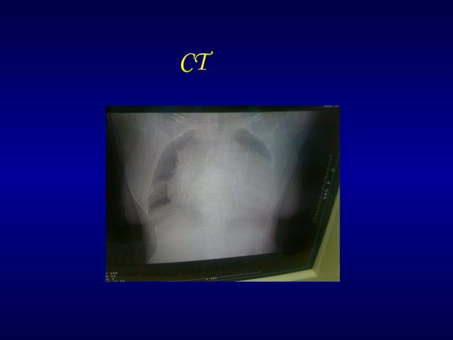 Drenajul pericardic percutan in pericardita neoplazica | PPT
