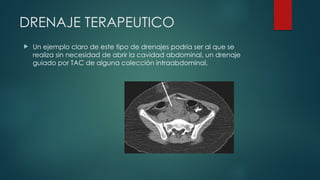 MANEJO DE DRENAJES EN PERITONITIS, REVISION SISTEMATICA .pptx