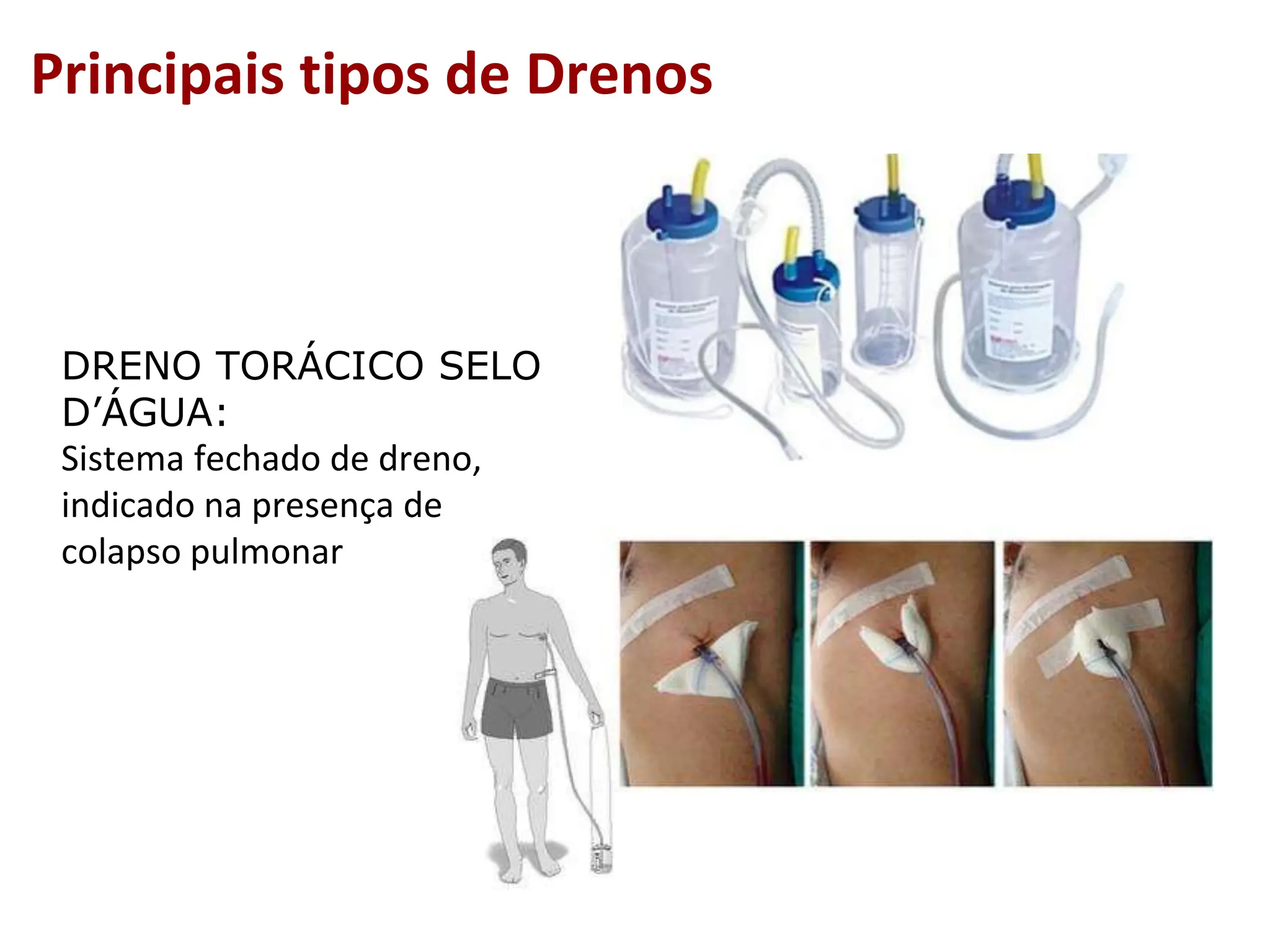 DRENOS E SONDAS YANA ENFERMAGEM EM CLÍNICA CIRÚRGICA.pptx