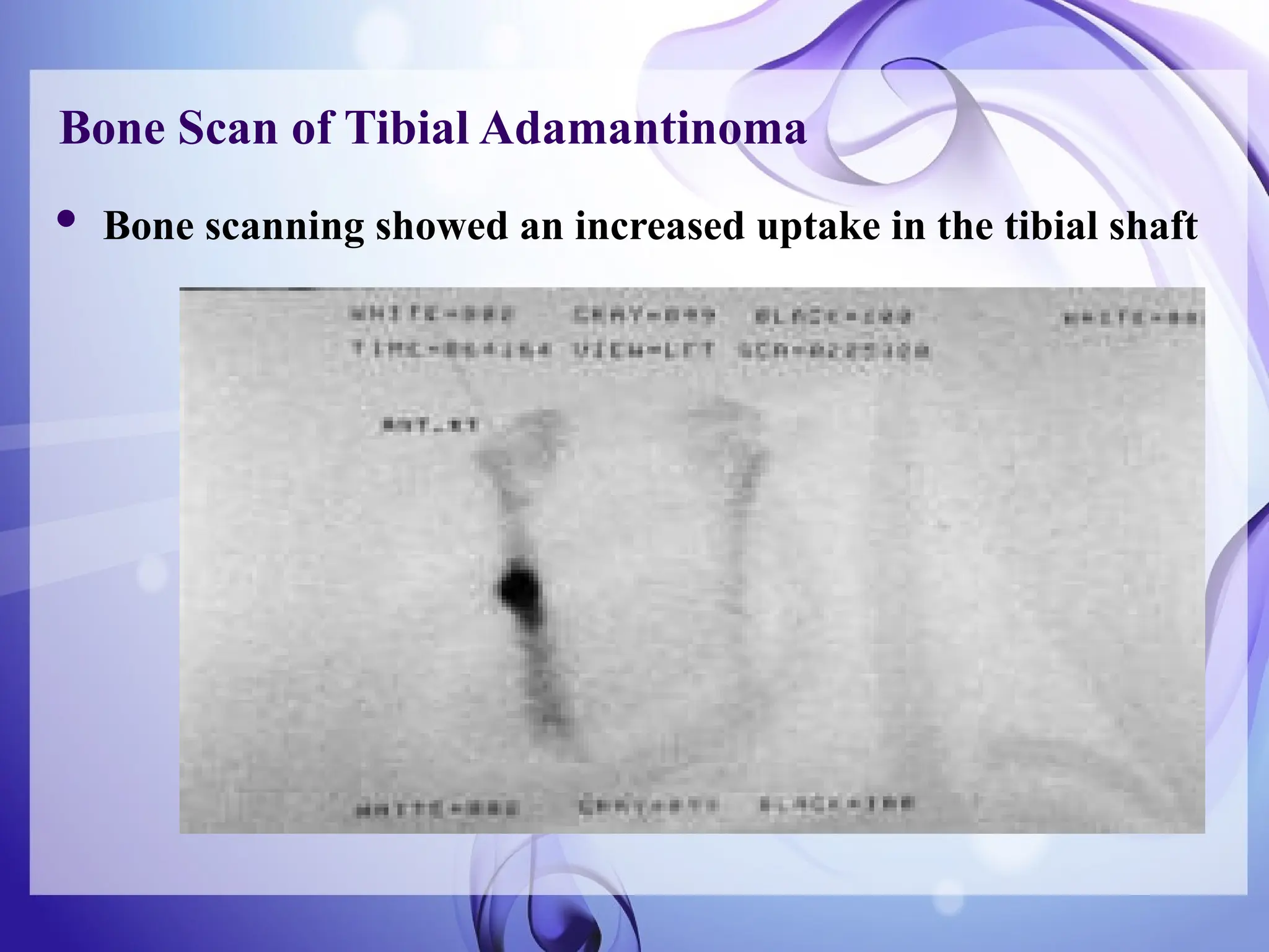 Adamatinoma of tibia primary of bone tumor | PPT