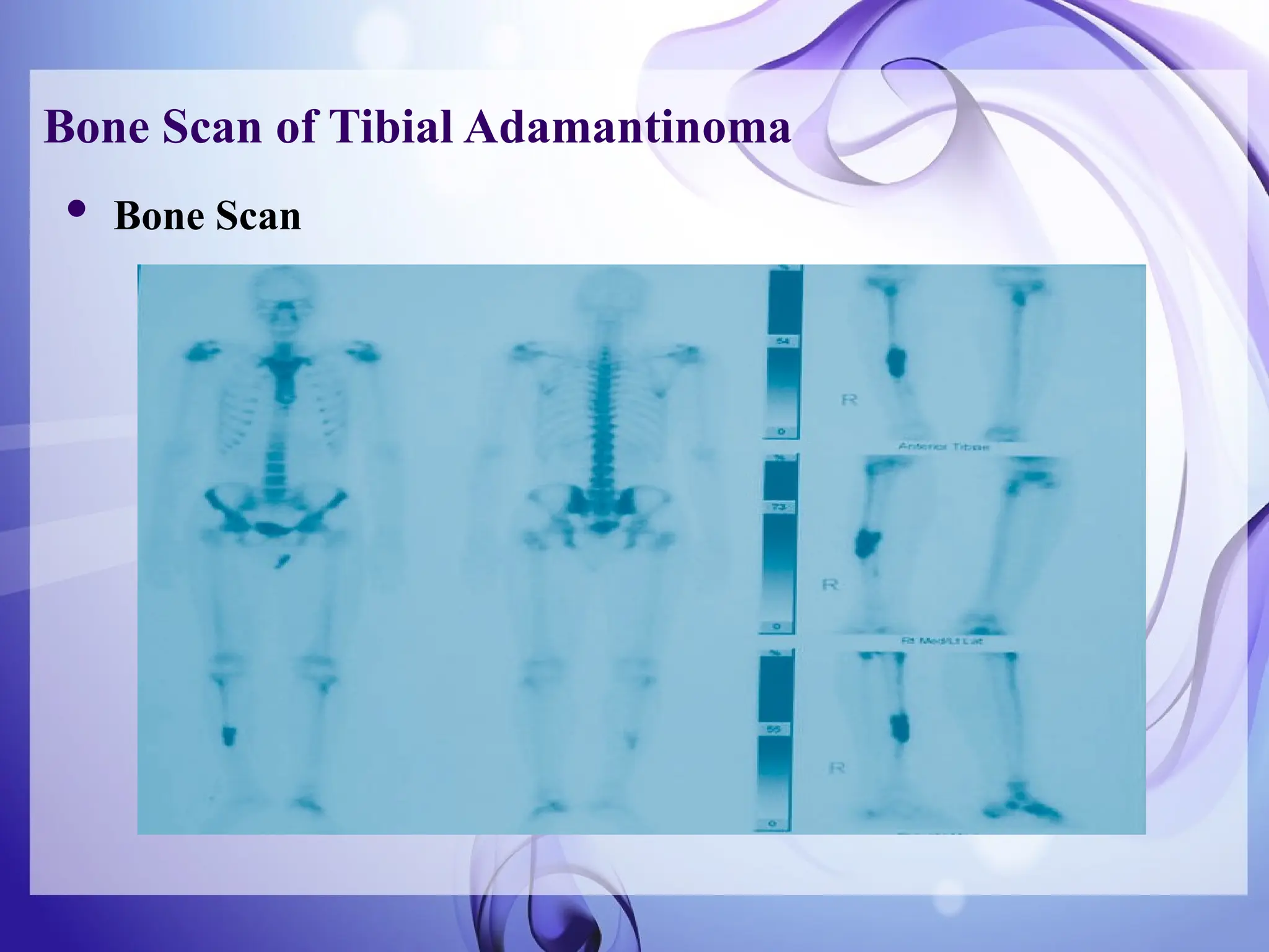 Adamatinoma of tibia primary of bone tumor | PPT