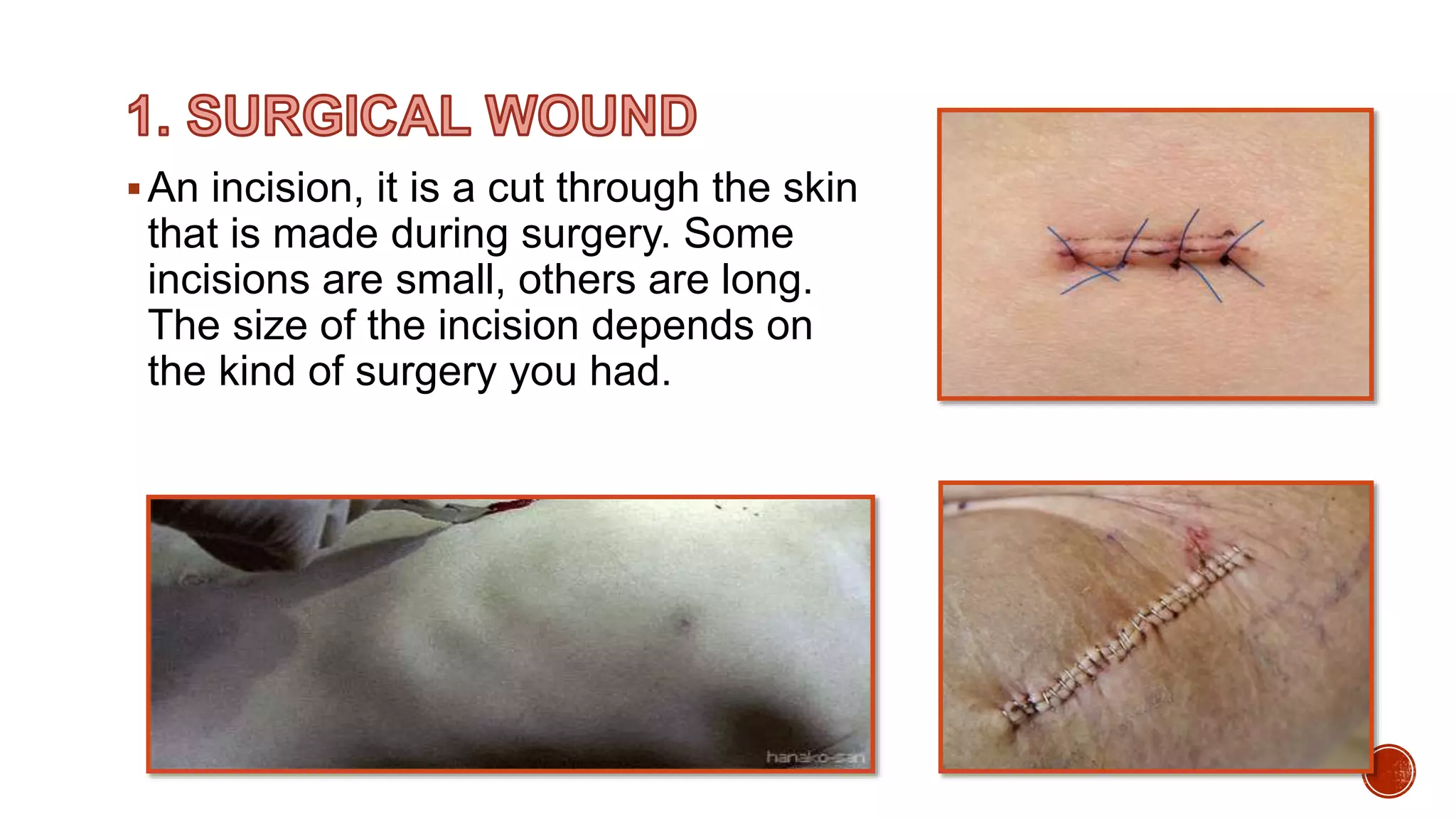 Dressing Surgical Wounds, Abrasion and Lacerations | PPTX