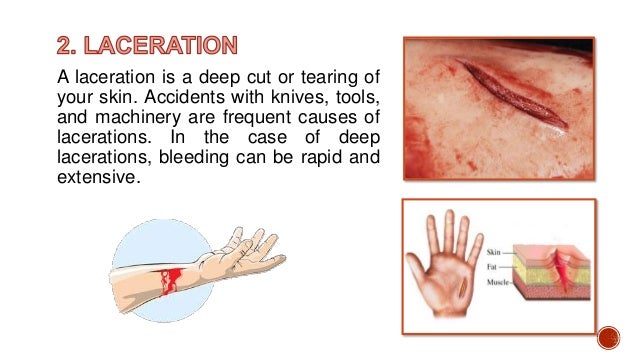 Abrasion Wound Diagram