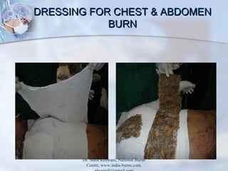 Dressing technique by Dr. Sunil Keswani, National Burns Centre, Airoli ...