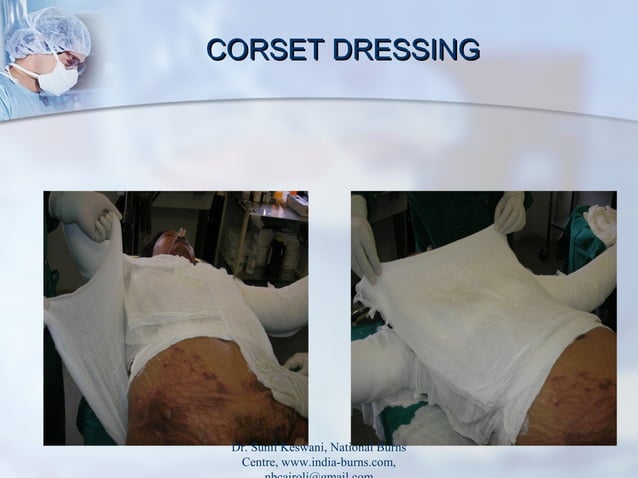 Dressing technique by Dr. Sunil Keswani, National Burns Centre, Airoli ...