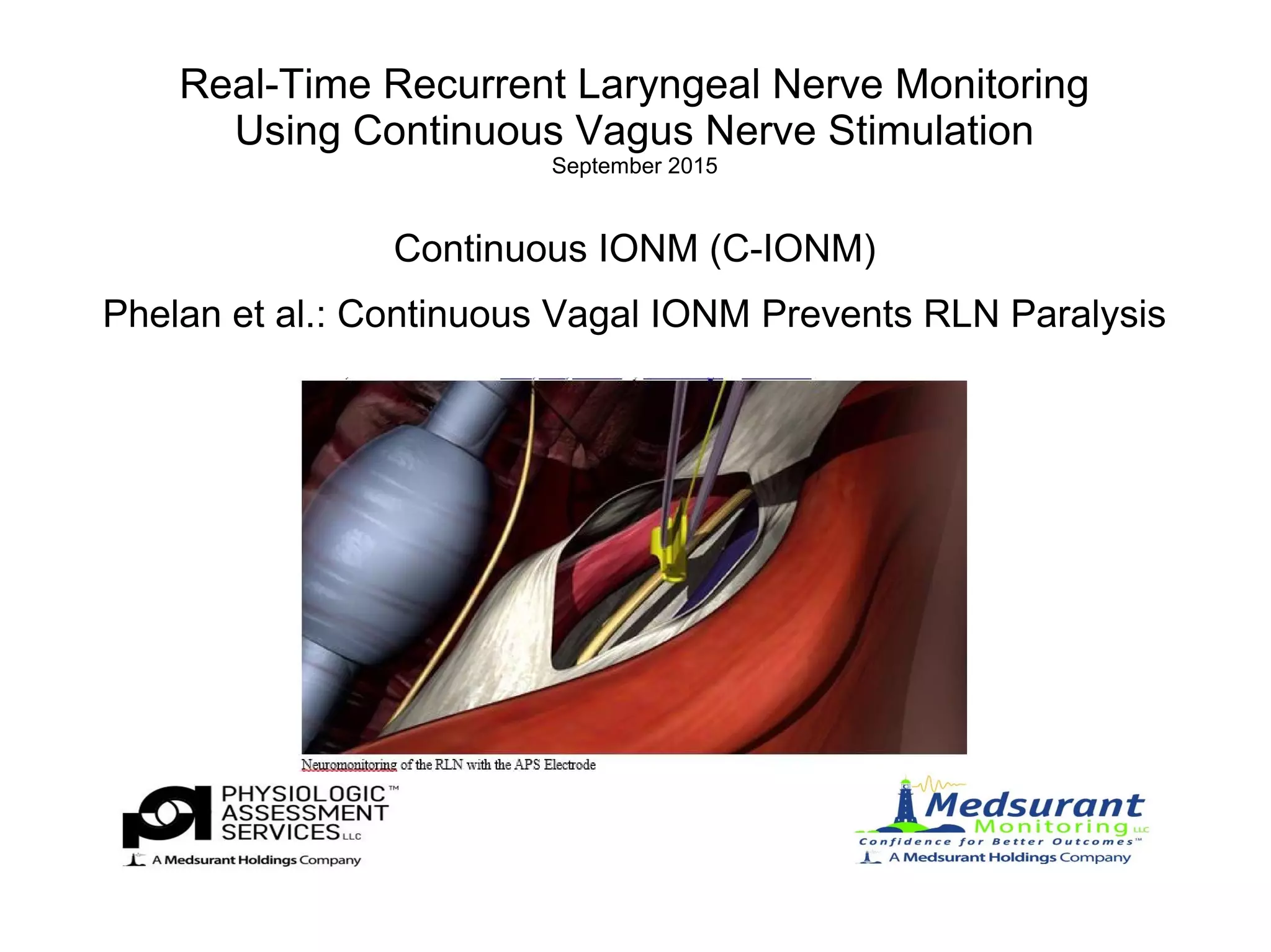 Real Time Recurrent Laryngeal Nerve Intraoperative Monitoring Using Continuous Vagus Nerve