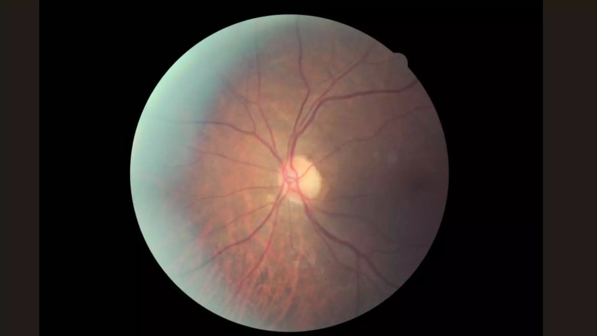 Diabetic Retinopathy Detection Using Cnn Image Classification Algorithm Pptx Eye And Vision