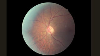 Diabetic Retinopathy Detection using CNN image classification algorithm ...