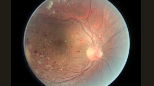 Diabetic Retinopathy Detection Using Cnn Image Classification Algorithm