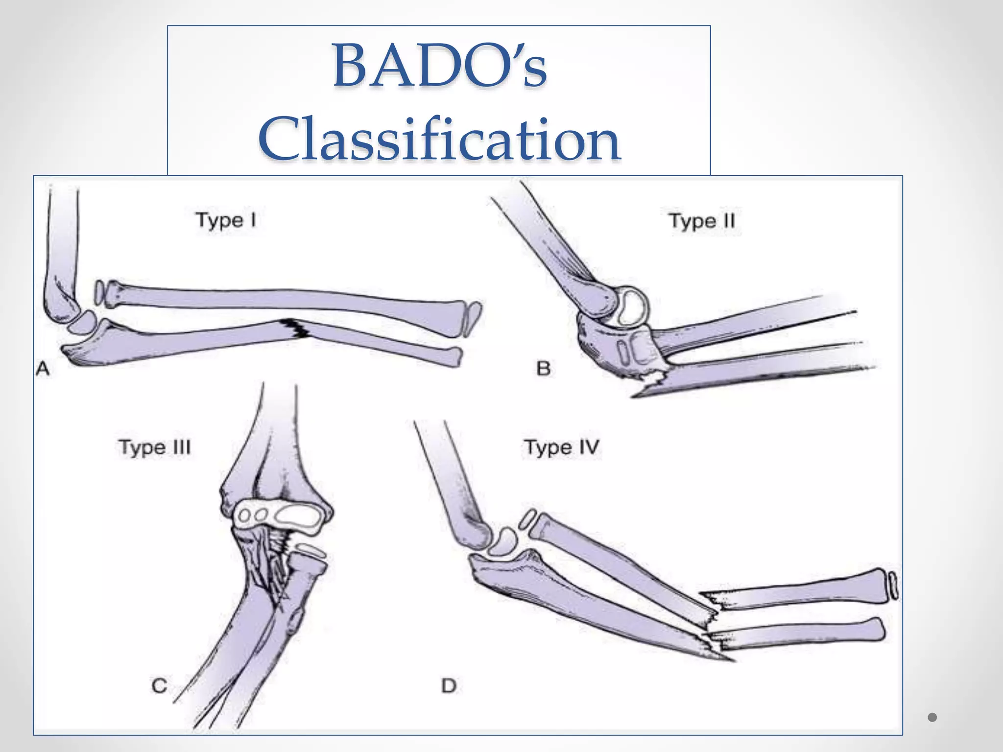 monteggia fracture | PPTX