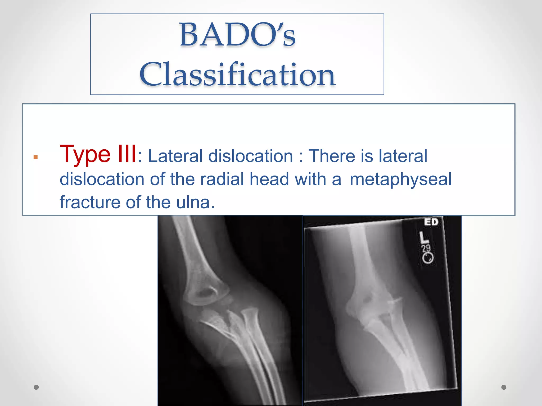 monteggia fracture | PPTX