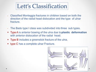 monteggia fracture | PPTX