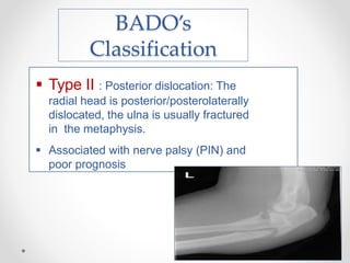 monteggia fracture | PPTX