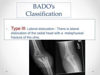 monteggia fracture | PPTX