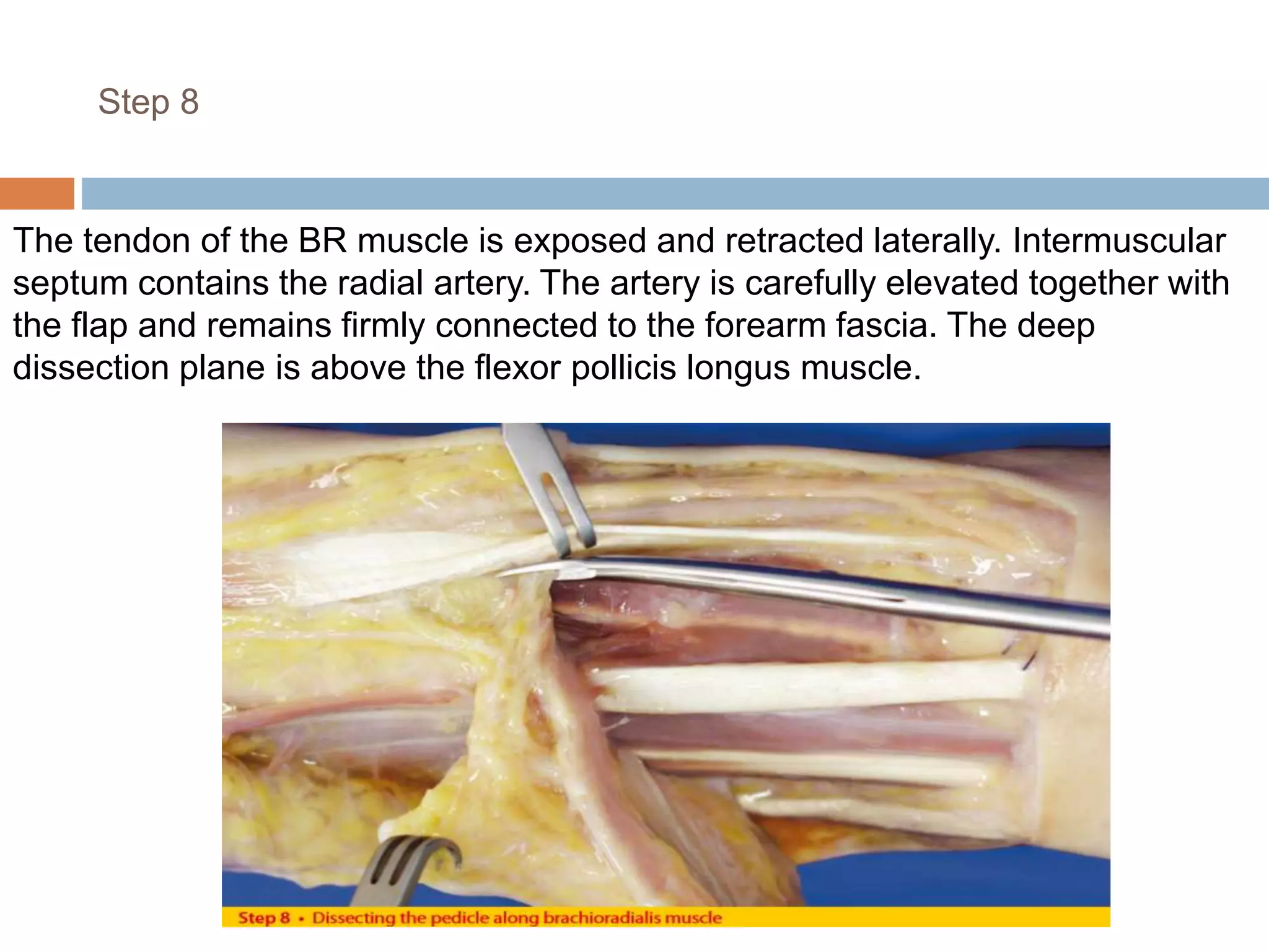 Radial Forearm Flap | PPTX