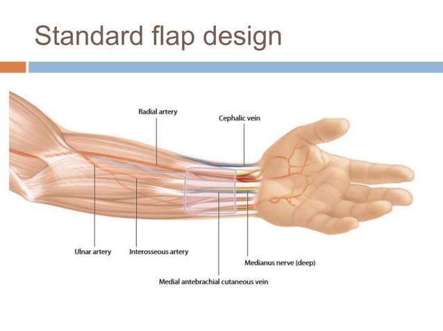 Radial Forearm Flap | PPTX