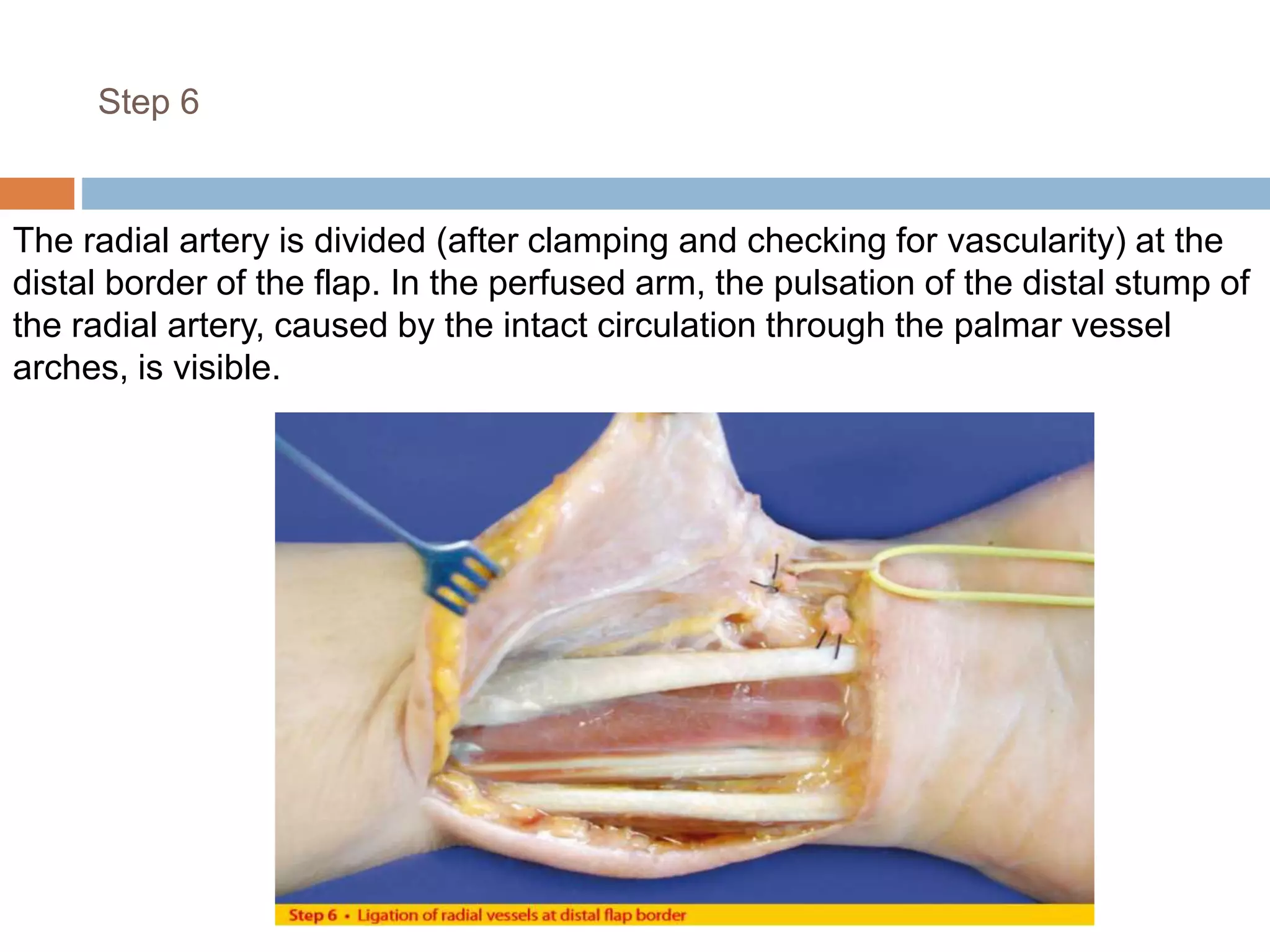 Radial Forearm Flap - Hand Surgery | PPTX