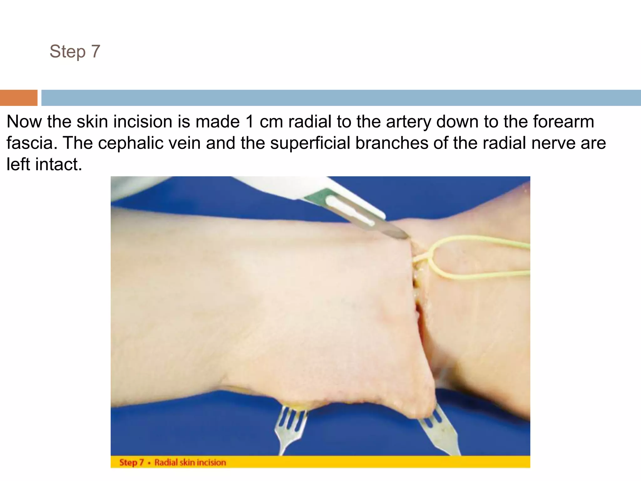Radial Forearm Flap - Hand Surgery | PPTX