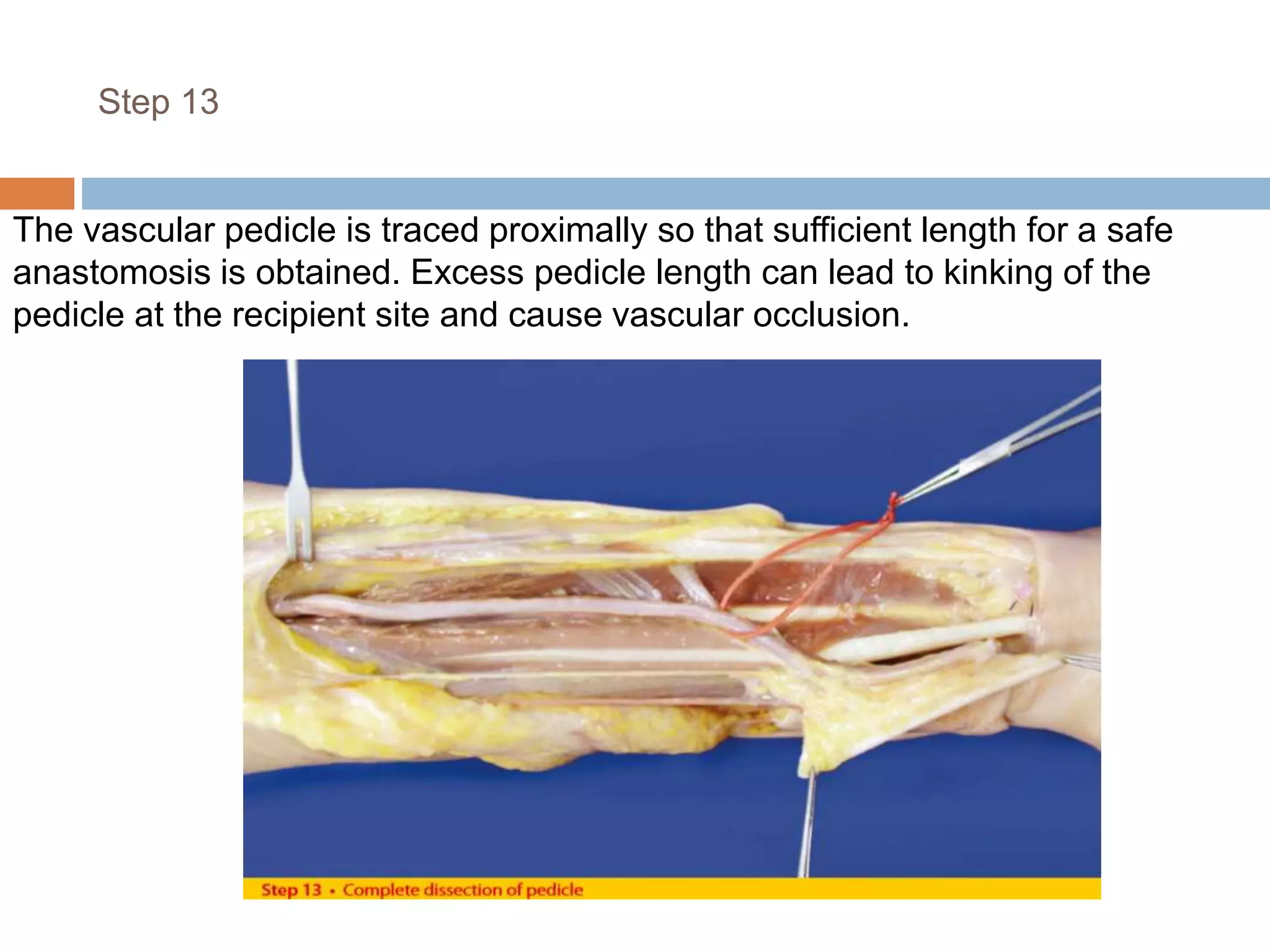 Radial Forearm Flap - Hand Surgery | PPTX