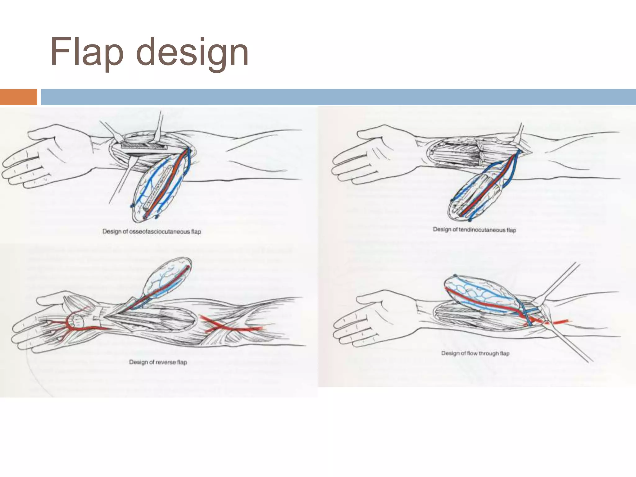 Radial Forearm Flap - Hand Surgery | PPTX