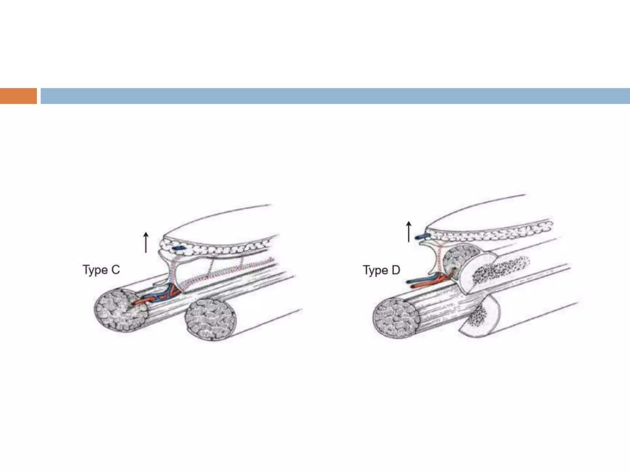 Radial Forearm Flap - Hand Surgery | PPTX