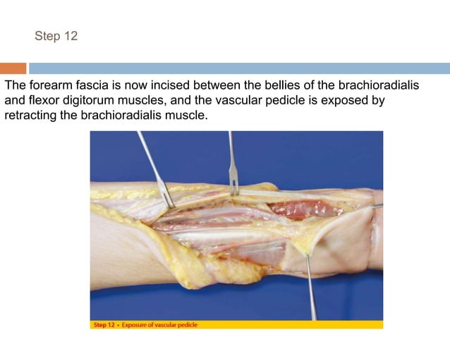 Radial Forearm Flap - Hand Surgery | PPTX