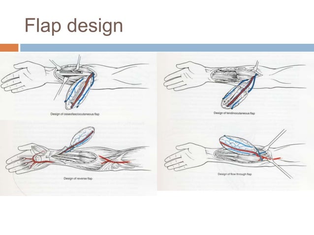 Radial Forearm Flap - Hand Surgery | PPTX