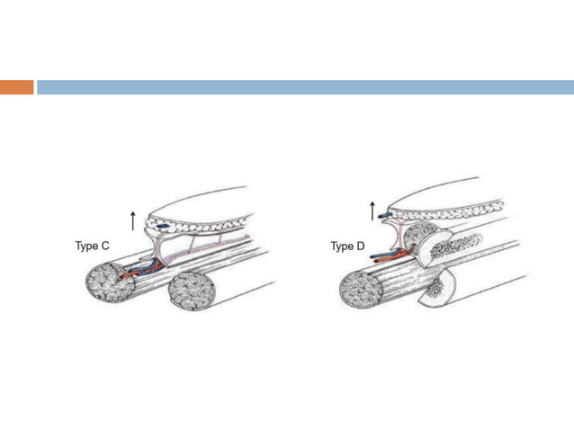 Radial Forearm Flap - Hand Surgery | PPT