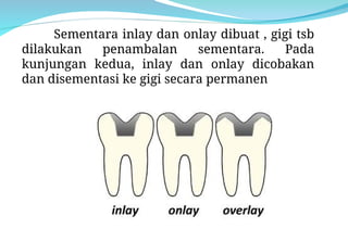 drg Yusrini - Restorasi Inlay, Onlay dan overlay (1).ppt