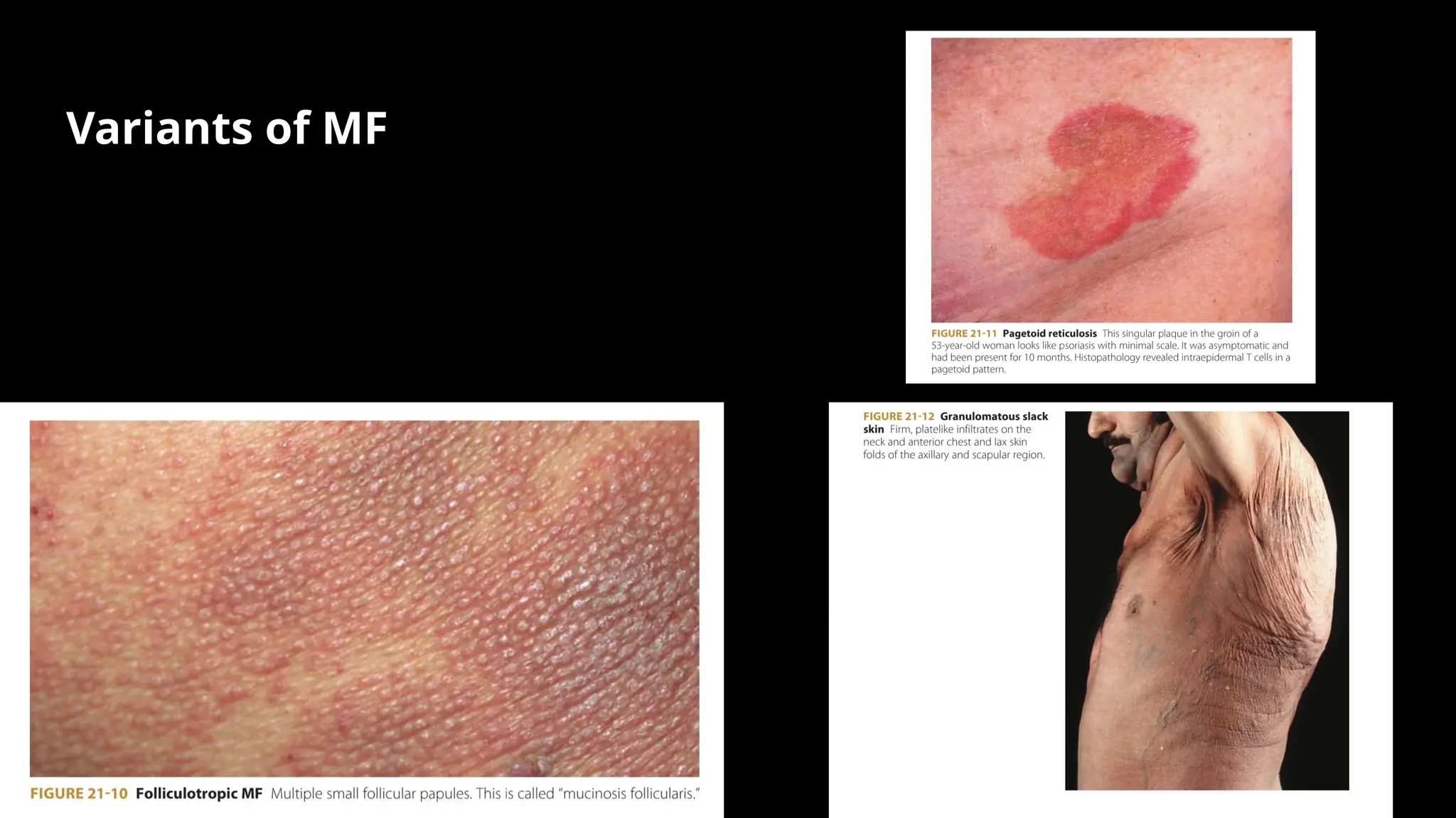 Cutaneous T-Cell Lymphoma and Total Skin Electron Beam Therapy ...