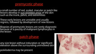 Cutaneous T-Cell Lymphoma and Total Skin Electron Beam Therapy ...