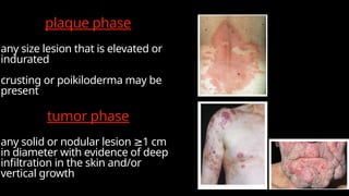 Cutaneous T-Cell Lymphoma and Total Skin Electron Beam Therapy ...