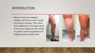 varicose veins management and diagnosis and treatment | PPTX