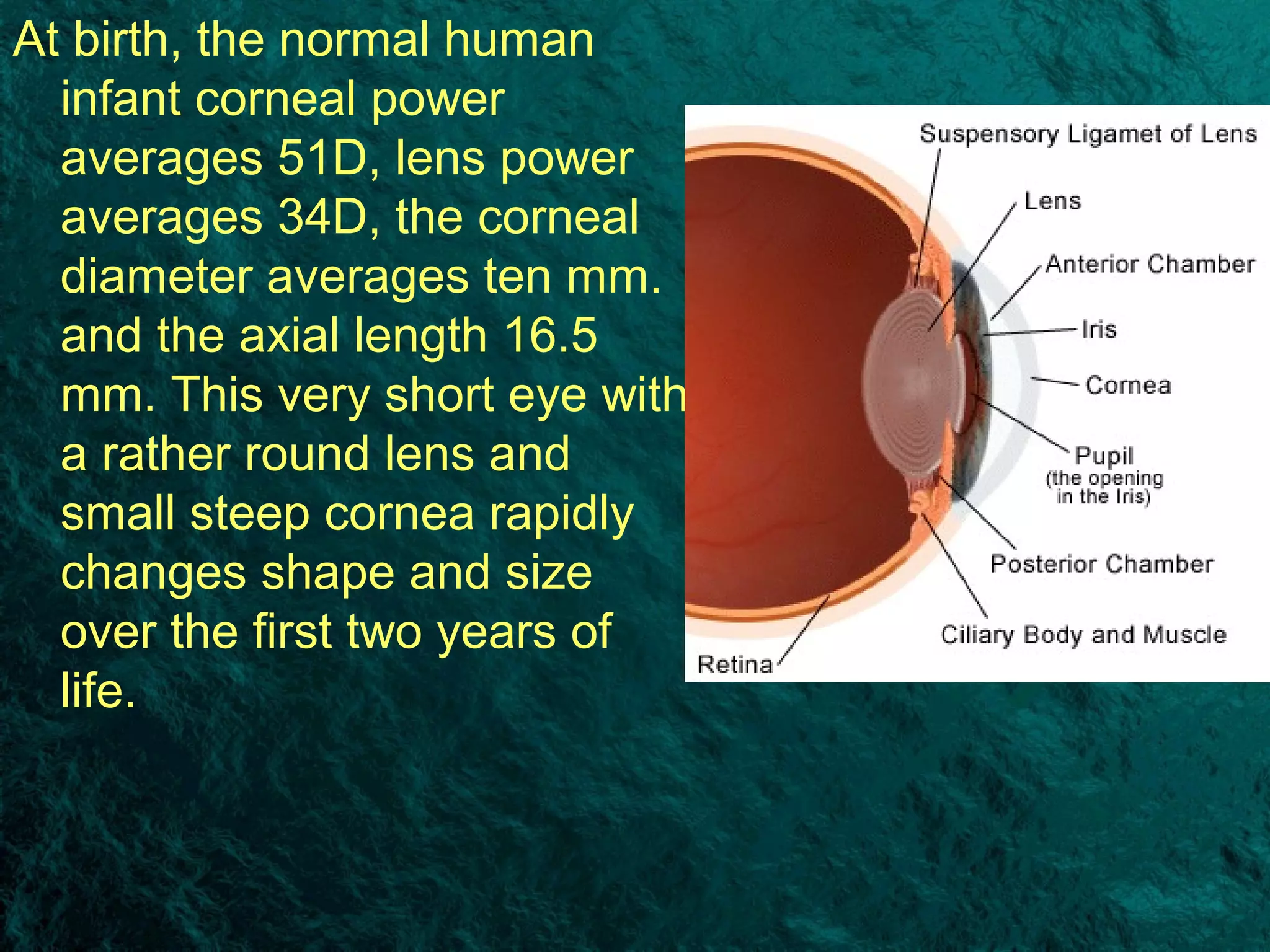 Congenital cataract | PPT